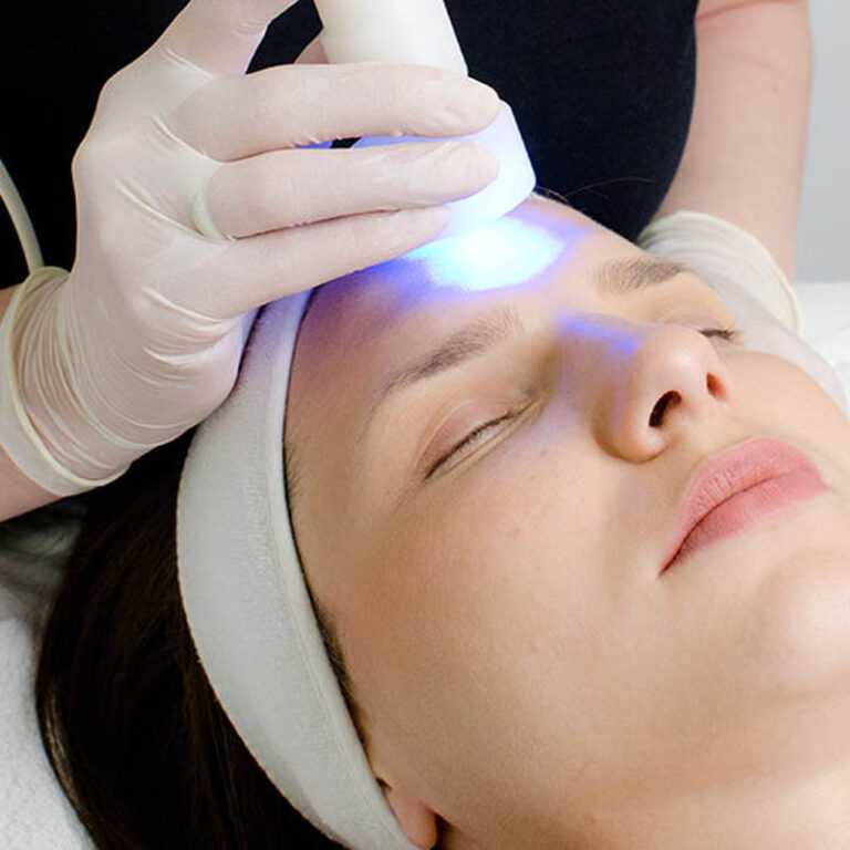 PDT low level laser for acne – Skin Laser Clinic